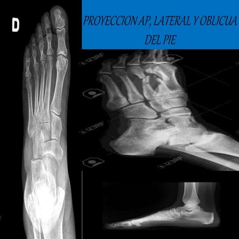 Proyeccion ap, lateral y oblicua del pie | PPTX