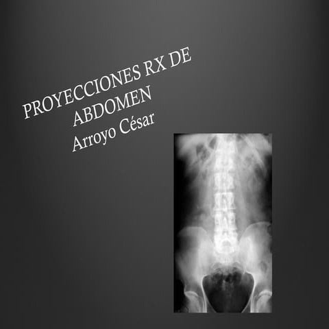 necrosis del parénquima pulmonar por Absceso | PPT