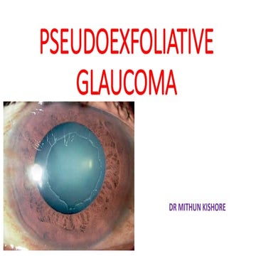 Pseudoexfoliative glaucoma seminar | PPTX