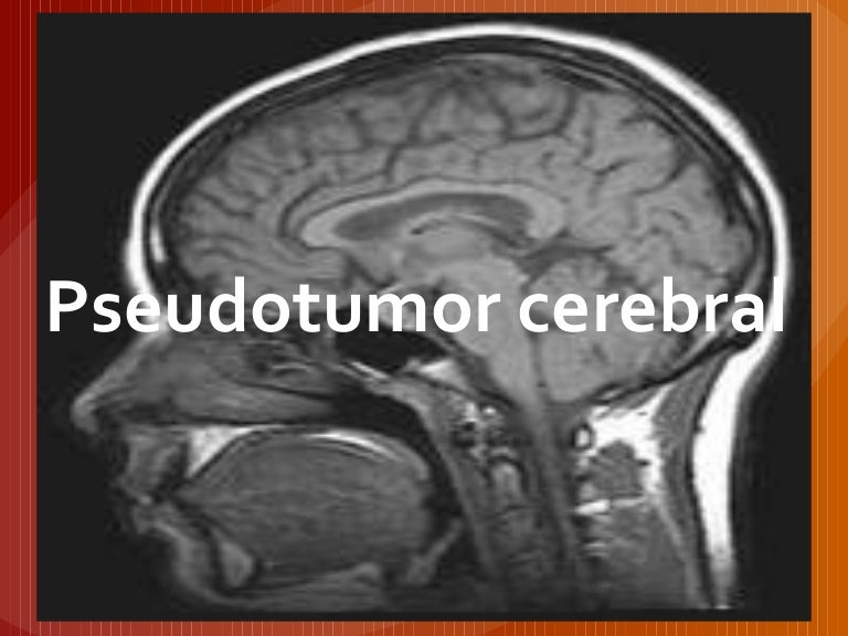 Pseudotumor cerebral
