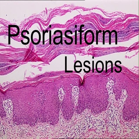 Parakeratosis Psoriasis