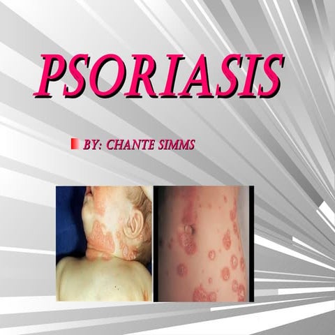 Psoriasis | PPT