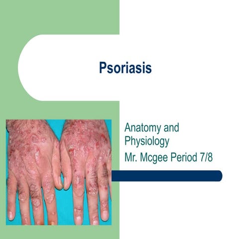 Psoriasis | PPT