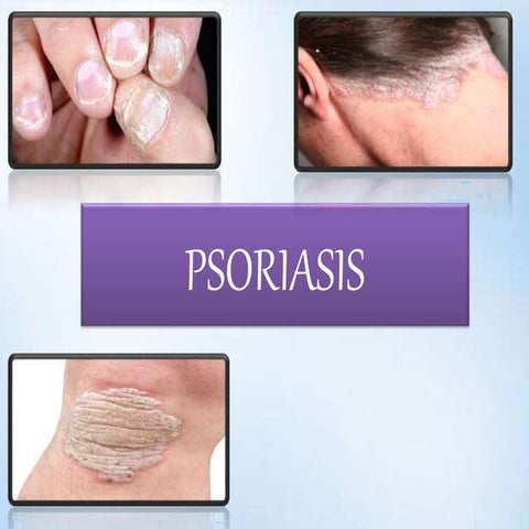 psoriasis complete information including therapy | PPT