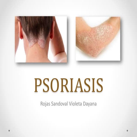 Psoriasis | PPT