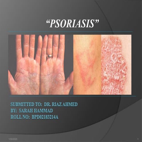 Psoriasis | PPTX