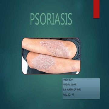 Psoriasis | PPTX