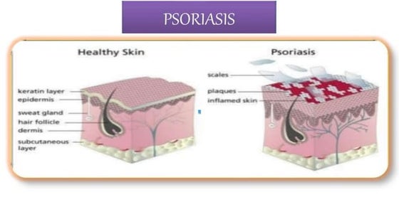 Psoriasis | PPT