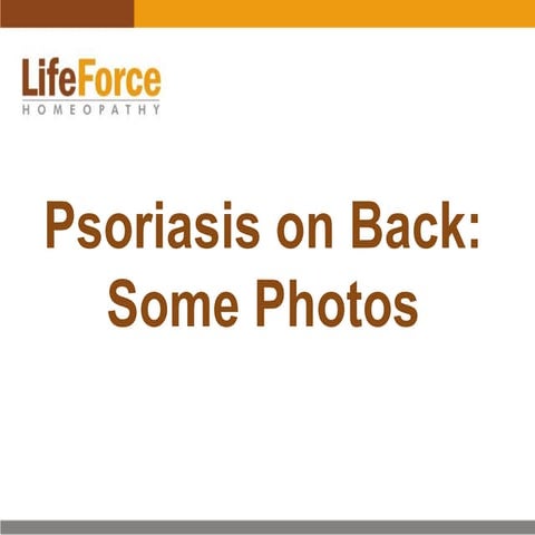 Psoriasis on Back Photos: Before After Treatment Pictures of Patients ...