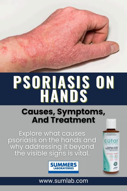 What are the main causes of psoriasis and eczema? | PDF