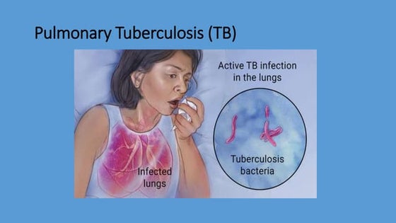 Tuberculosis Tuberculosis Tuberculosis Tuberculosis | PPT