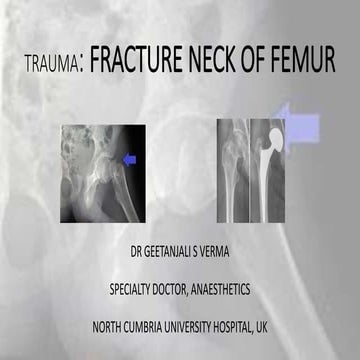 Fracture NOF: guidelines & audit | PPTX