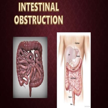 intestinal obstruction | PPTX
