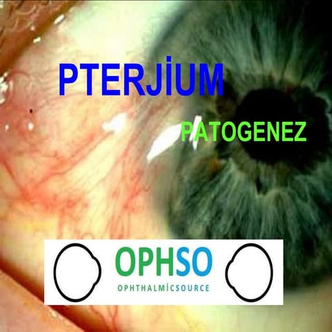 Pterjium patogenez | PPT