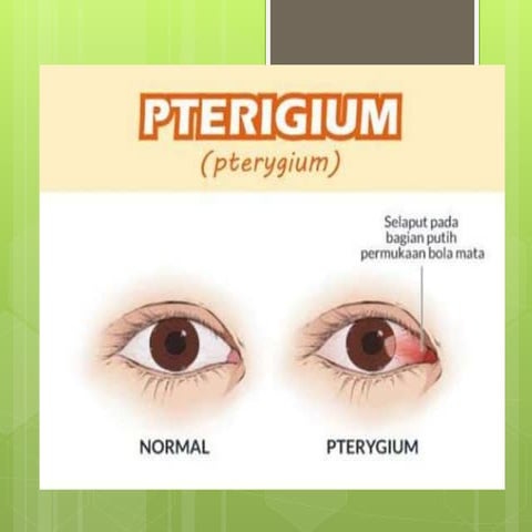 pterygium.pptx