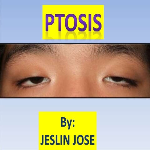 ptosis-190331084432.pptx