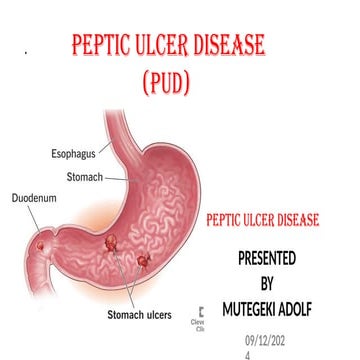 Peptic Ulcer Desease (PUD), Sores in the gastrium | PPTX
