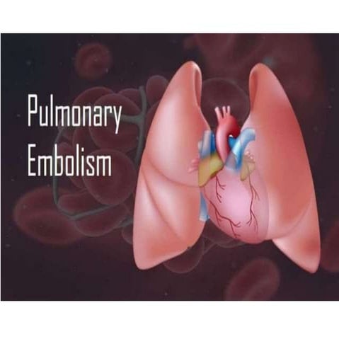 pulmonary-embolism | PPT