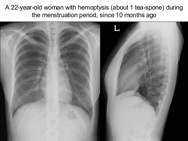 Pulmonary Endometriosis