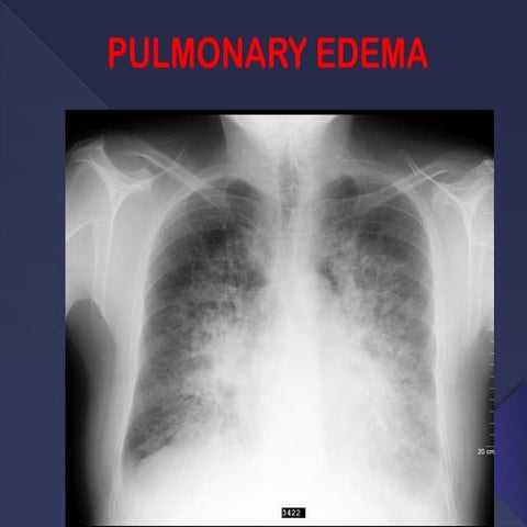 Cardiogenic vs noncardiogenic pulmonary edema (ARDs) | PPTX