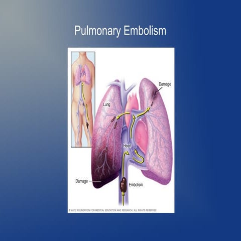 Pulmonary embolism ppt | PPTX