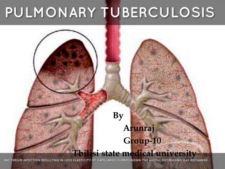 Pulmonary tuberculosis