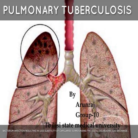 Pulmonary tuberculosis | PPTX