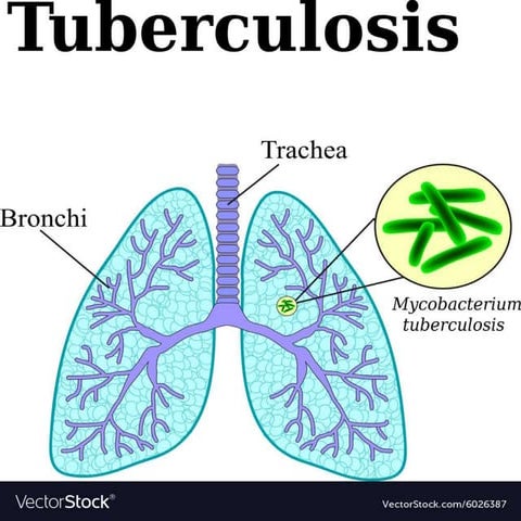 Tuberculosis Lungs Diagram