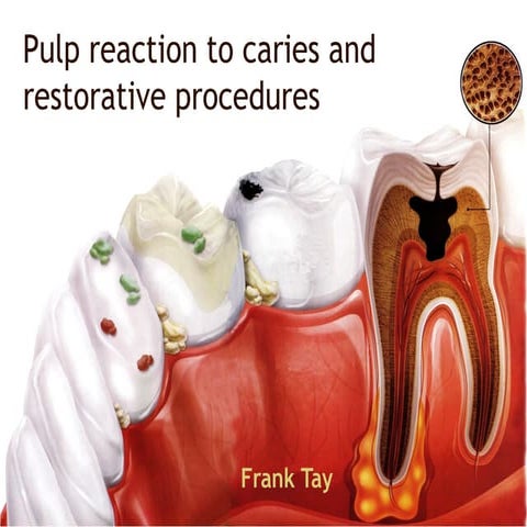 Pulp rection to caries and restorative procedures.pptx