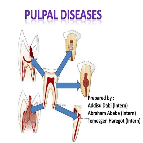 Pulpal diseases | PPTX