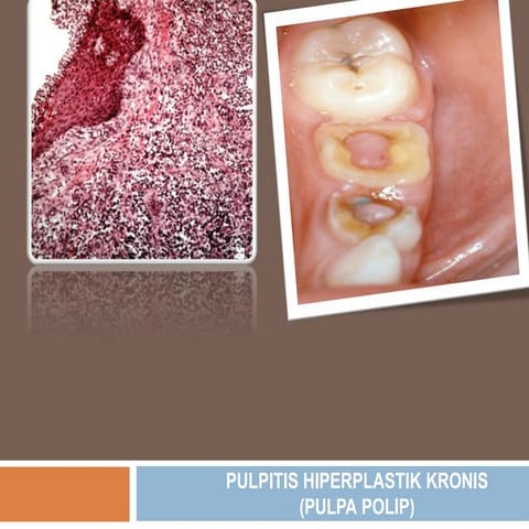 kejadian pulpa polip pada gigi permanen dewasa | PPTX