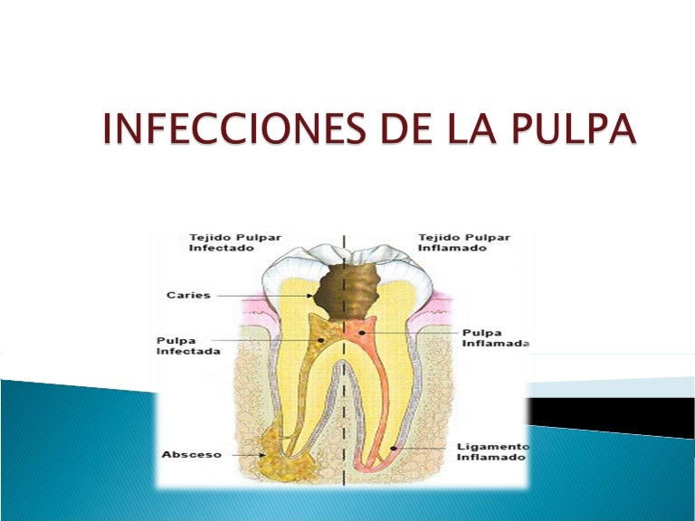 Pulpitis
