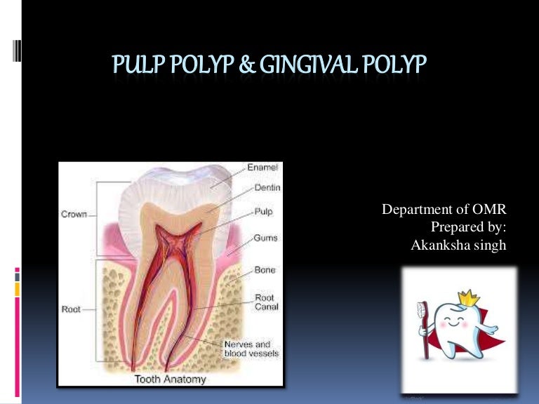 Pulp polyp and gingival polyp