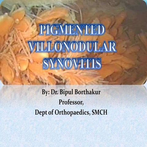 Pigmented villonodular synovitis | PPTX