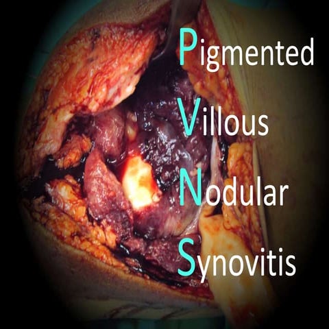 Pigment villos nodular Synovitis PVNS | PPT