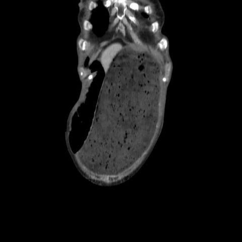 Pyloric obstruction coronal | PPTX