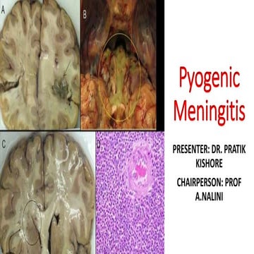Pyogenic meningitis (nimhans) | PPTX