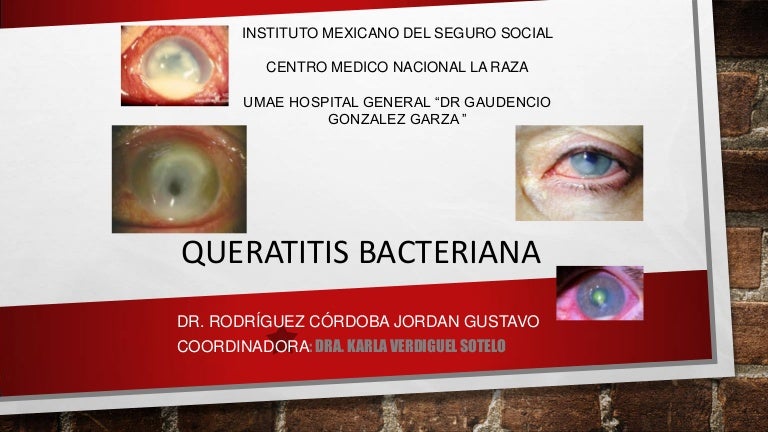 Queratitis bacteriana