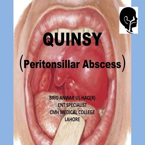 Quinsy or Peritonsillar Abscess | PPTX