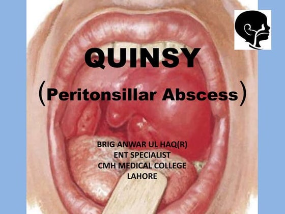 Quinsy or Peritonsillar Abscess.pptx
