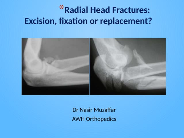 Radial head fracture | PPTX