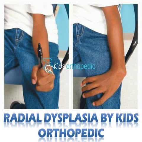 Radial Dysplasia By Kids Orthopedic | PPT