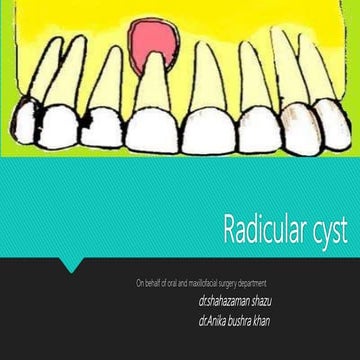 Radicular cyst | PPTX