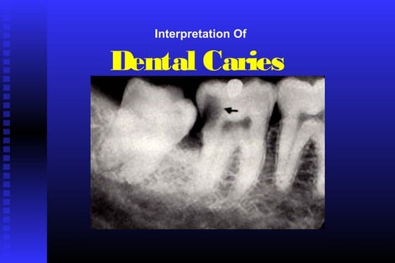 radiographic of interpretation of dental caries | PPT