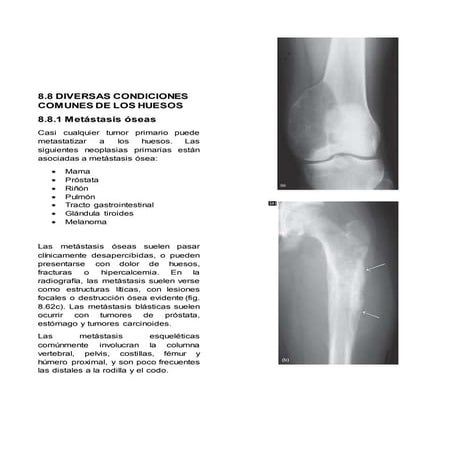 RadiologÍa de Metástasis Ósea y Columna Vertebral | DOCX