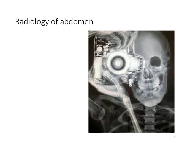 Intravenous pyelogram | PPTX