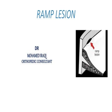 Ramp lesion | PPTX