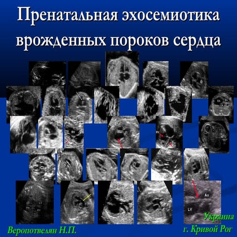 Пренатальная эхосемиотика ВПС | PPT