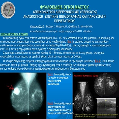 Φυλλοειδής όγκος μαστού | PPT