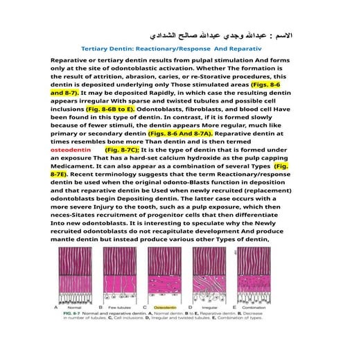 Tertiary Dentin: Reactionary/Response and Reparativ | DOCX